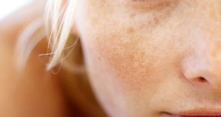 Taches pigmentaires - Docteur Amina Laasri - Médecine Esthétique Casablanca